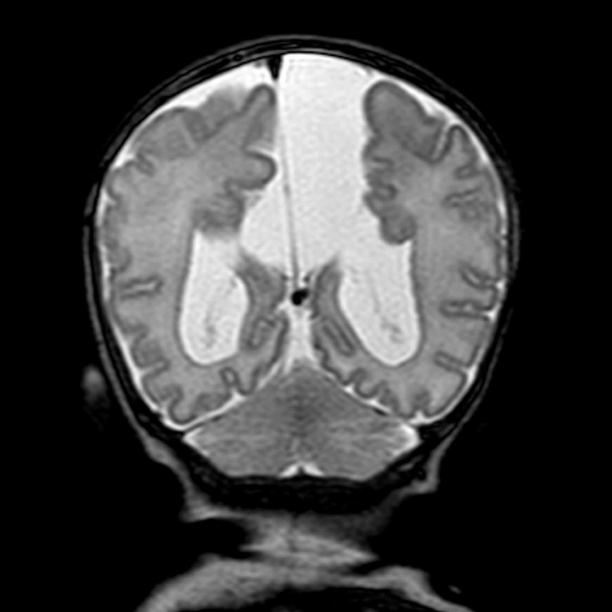 Postnatální MRI • Česká Neonatologická Společnost 2025