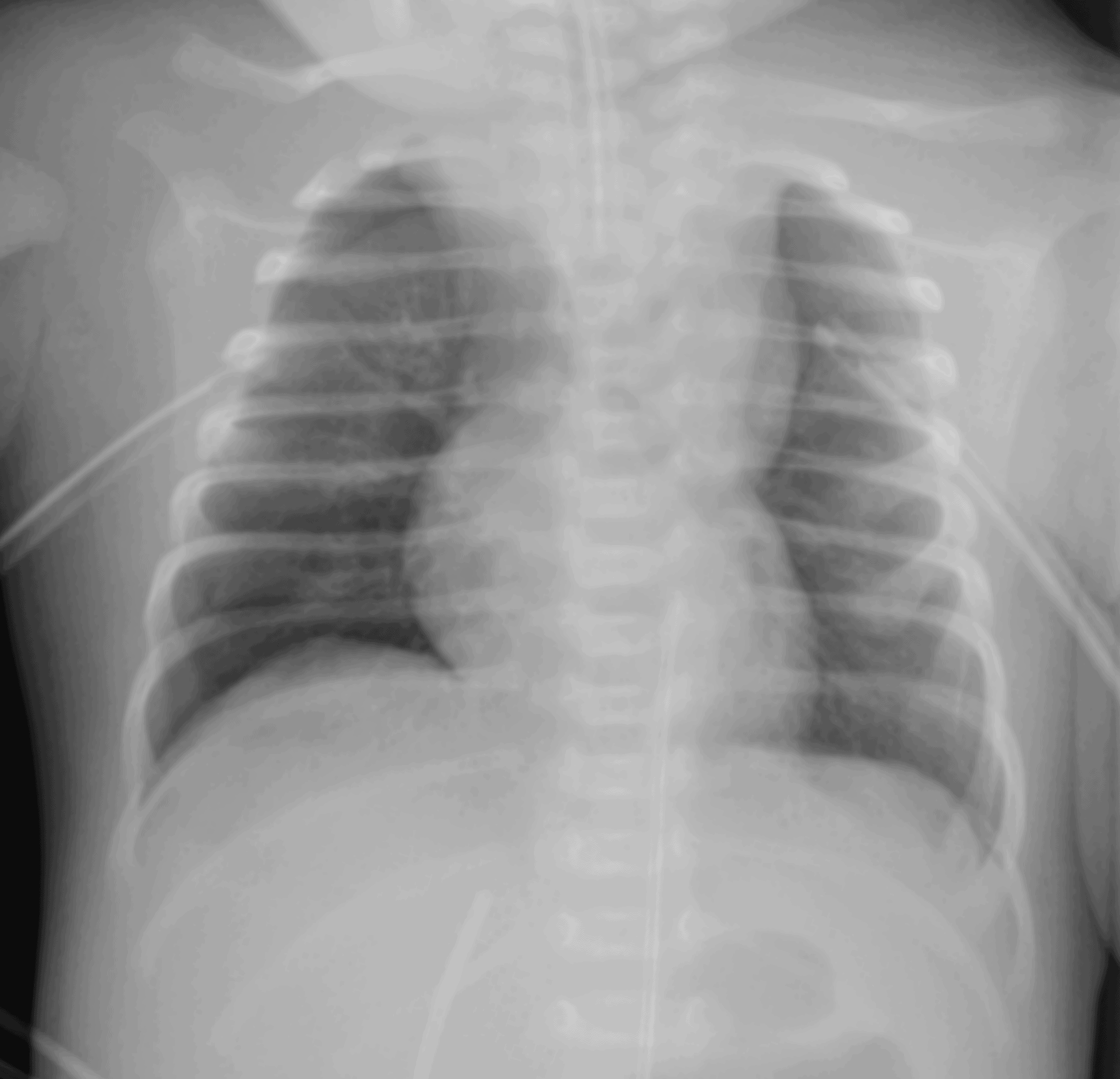 RTG hrudníku • Česká Neonatologická Společnost 2025