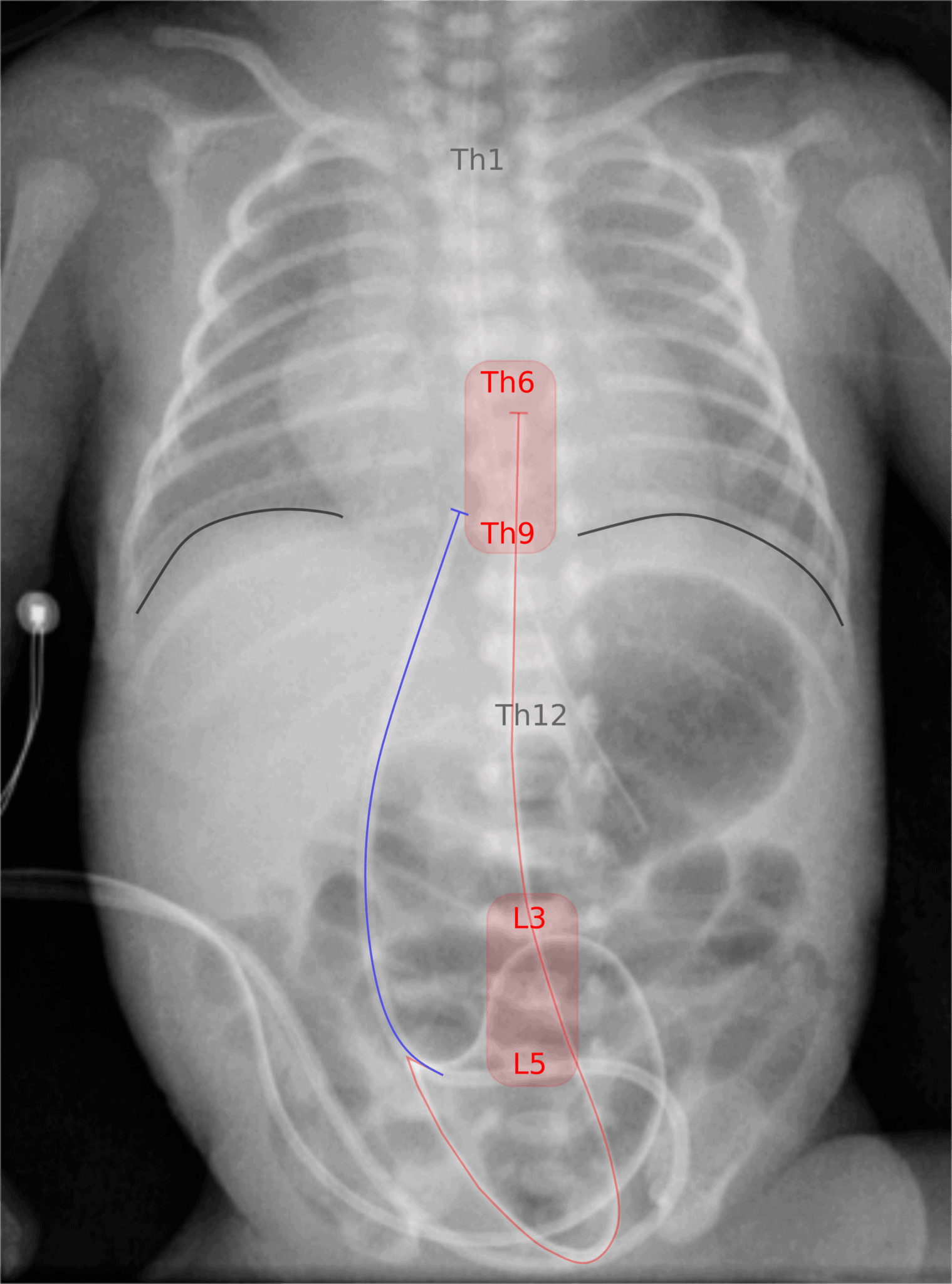 RTG hrudníku • Česká Neonatologická Společnost 2025