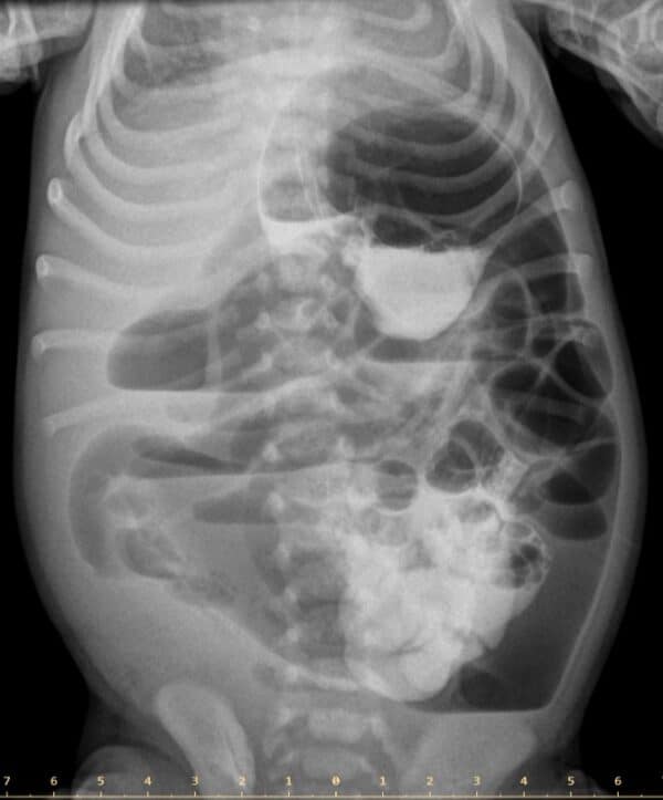 RTG břicha • Česká Neonatologická Společnost 2025