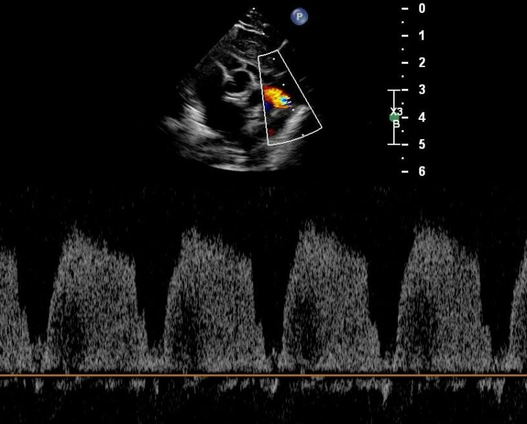 Otevřená tepenná dučej • Česká Neonatologická Společnost 2025